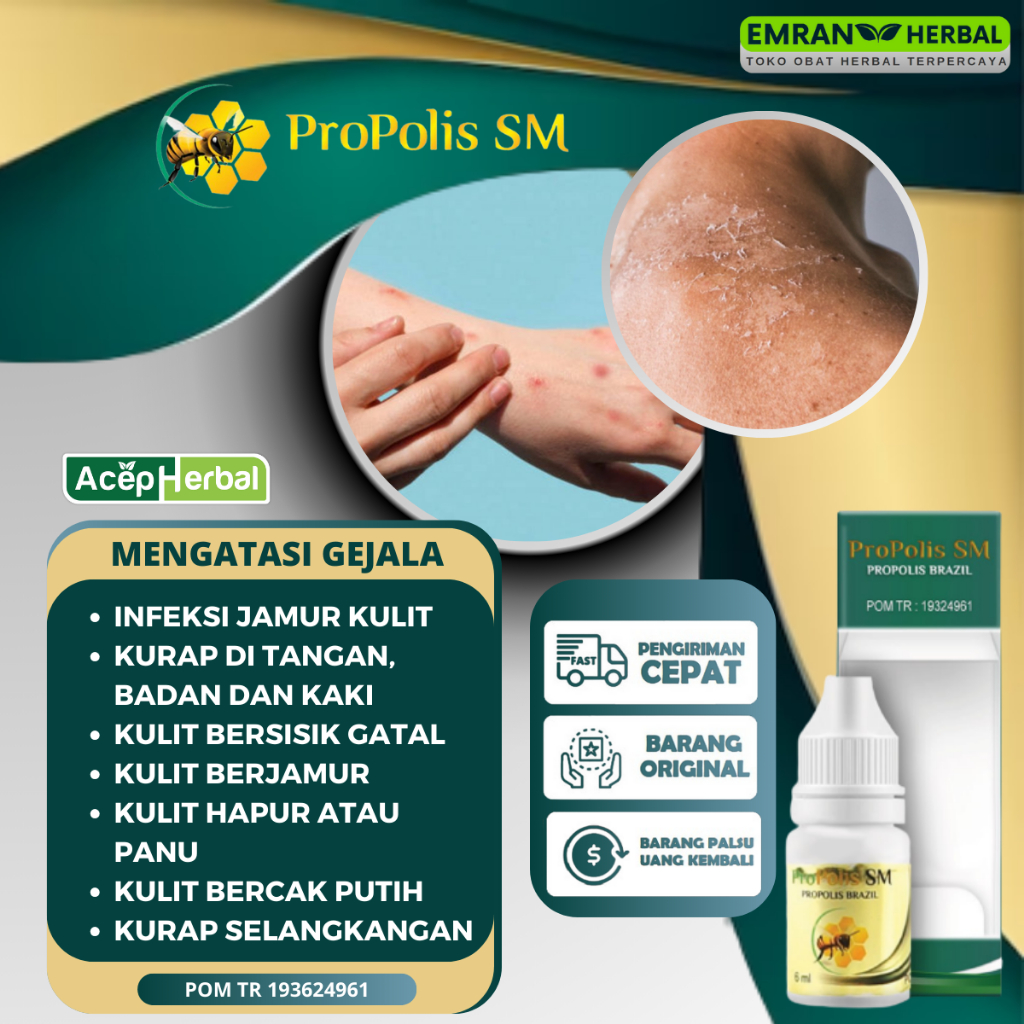 Jual Obat Infeksi Jamur Kulit, Kurap di Tangan, Kurap di Badan, Kurap ...