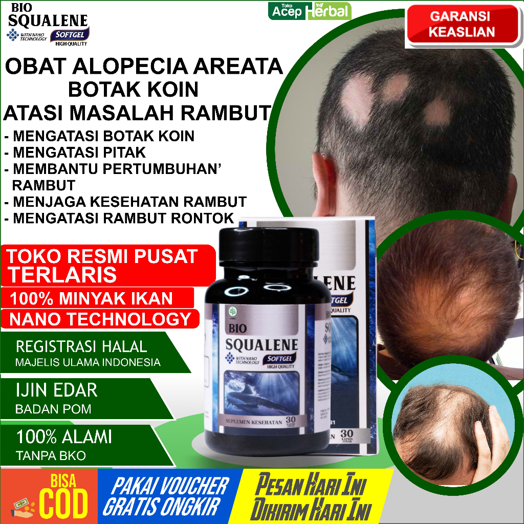 Jual Obat Alopecia Areata Botak Rambut Pitak Penumbuh Rambut Rambut ...