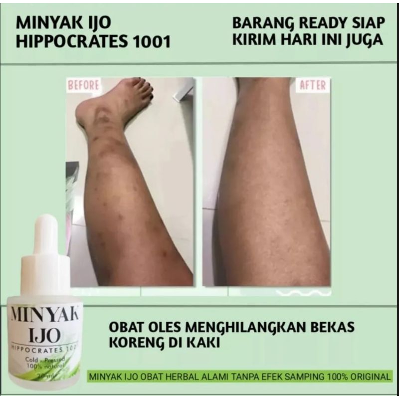 Jual MINYAK IJO OBAT | PENGHILANG BEKAS LUKA KORENG | LUKA DIABETES ...