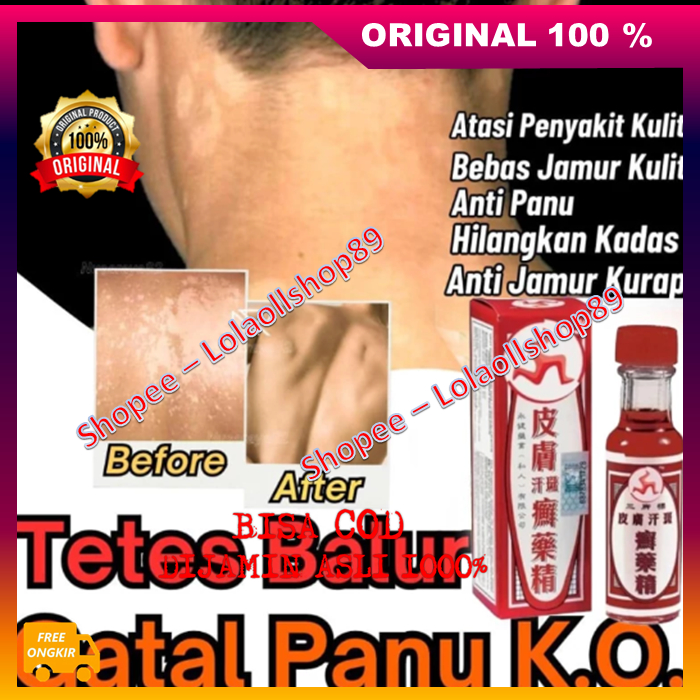 Jual Tetes Balur Gatal Panu Obat Tradisional Tiongkok Atasi Penyakit ...