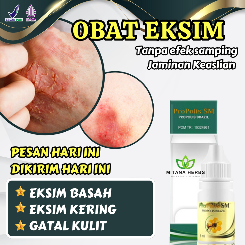Jual Obat Eksim Kering Menahun - Obat Eksim Basah - Obat Eksim Kering ...