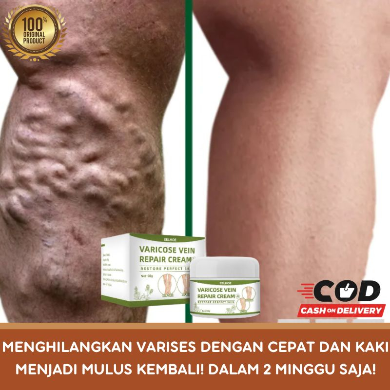 Jual [Best Seller] Krim Salep China Untuk Pengobatan Varises kaki ...