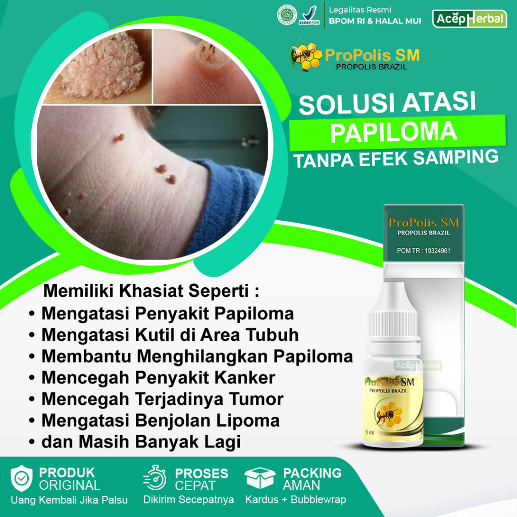 Jual Obat Papiloma, Obat Penghilang Papiloma, Obat Kutil, Obat ...