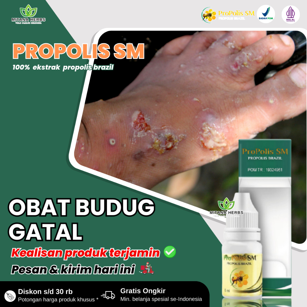 Jual Obat Budug Kulit Gatal Budug Di Kaki Budug Santri Budug Bernanah ...
