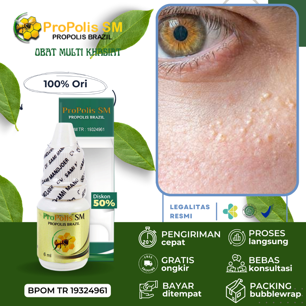 Jual Propolis SM - Obat Penghilang Milia di Bawah Mata Bintik Putih ...