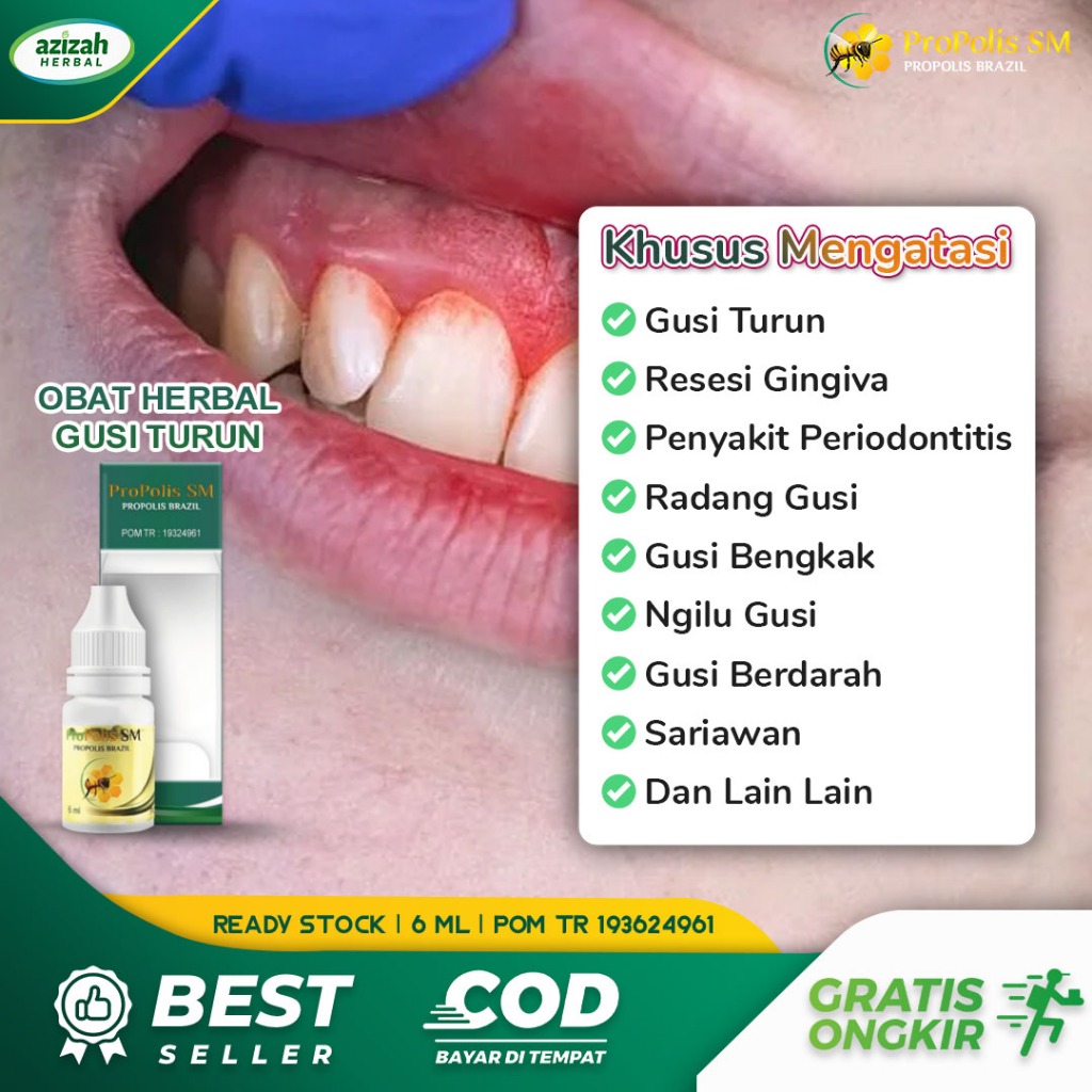 Jual Obat Gusi Turun Merosot Resesi Gingiva Periodontitis Radang Gusi ...
