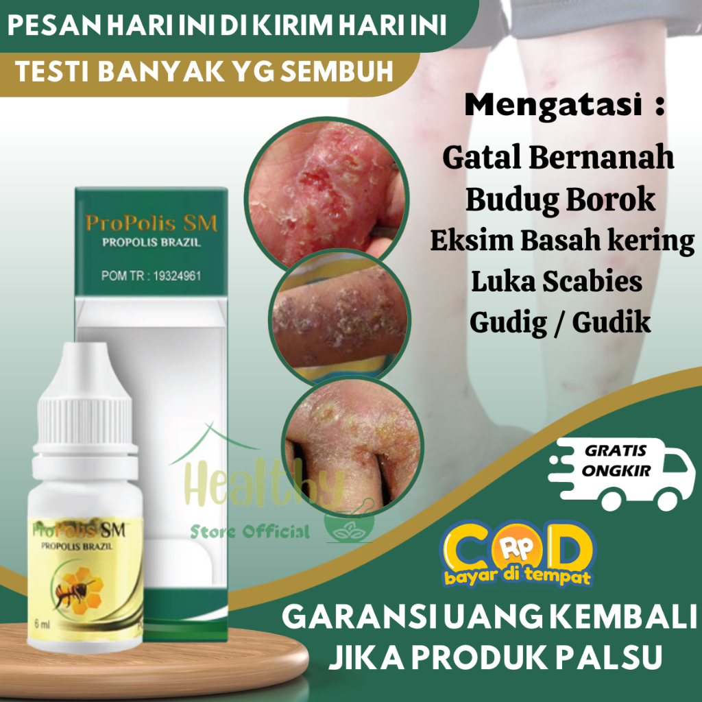 Jual Obat Scabies Manusia, Obat Gatal Kulit Seluruh Badan, Obat Budug ...