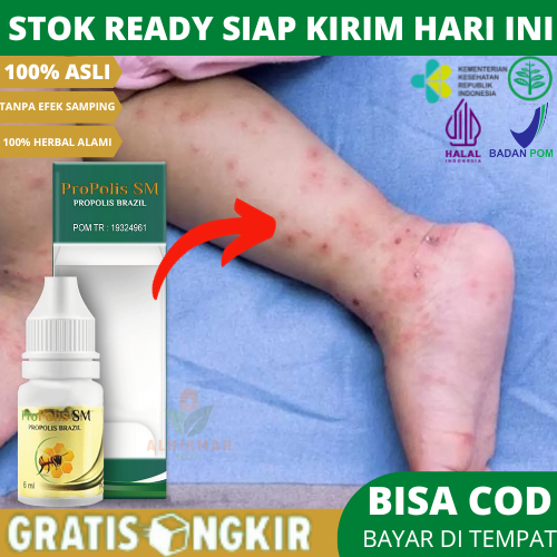 Jual Obat Darah Manis, Penyakit Prurigo, Penghilang Gatal Gatal Pada ...