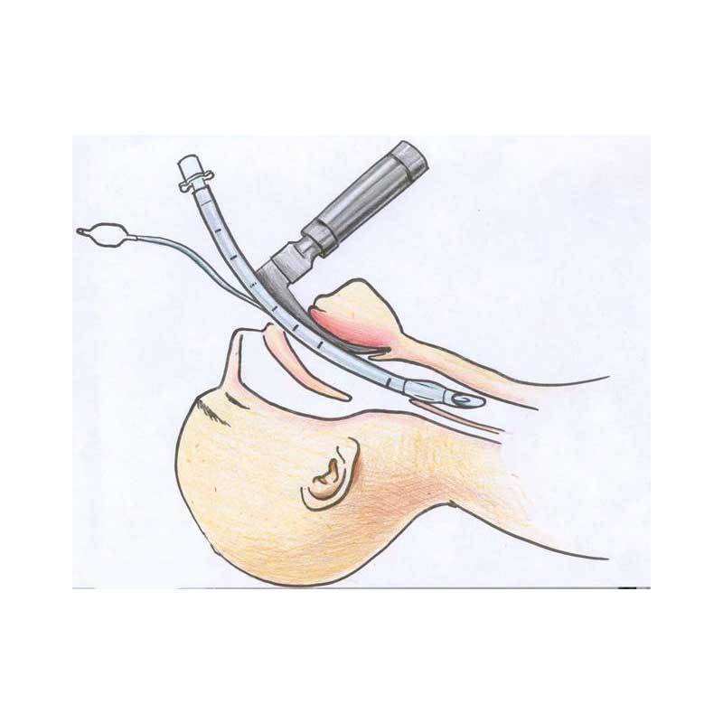 Jual 5pcs/set Guedel Airway No.3 90mm Kuning Dan No.4 100mm Merah ...