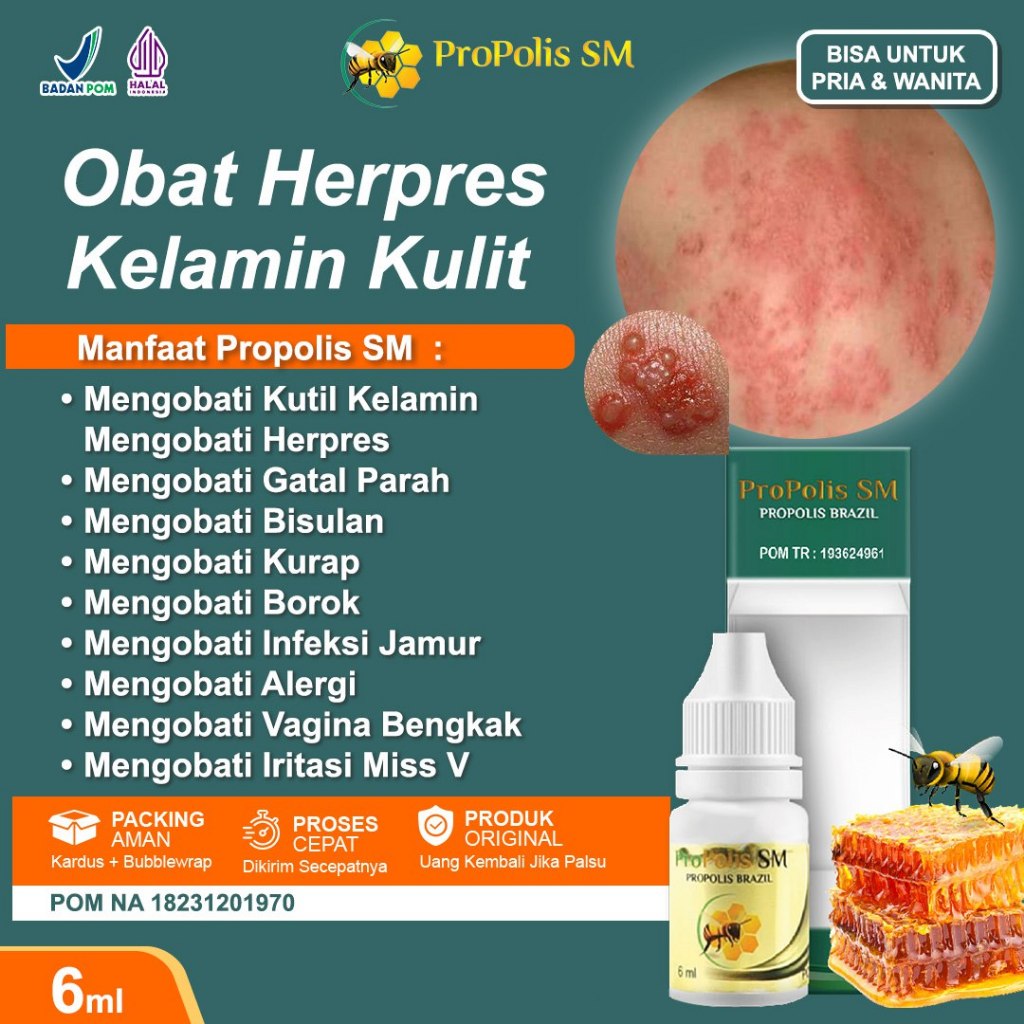 Jual Obat Herpes Kelamin Kulit Gatal Bintik Bintik Berair Bisa Untuk ...