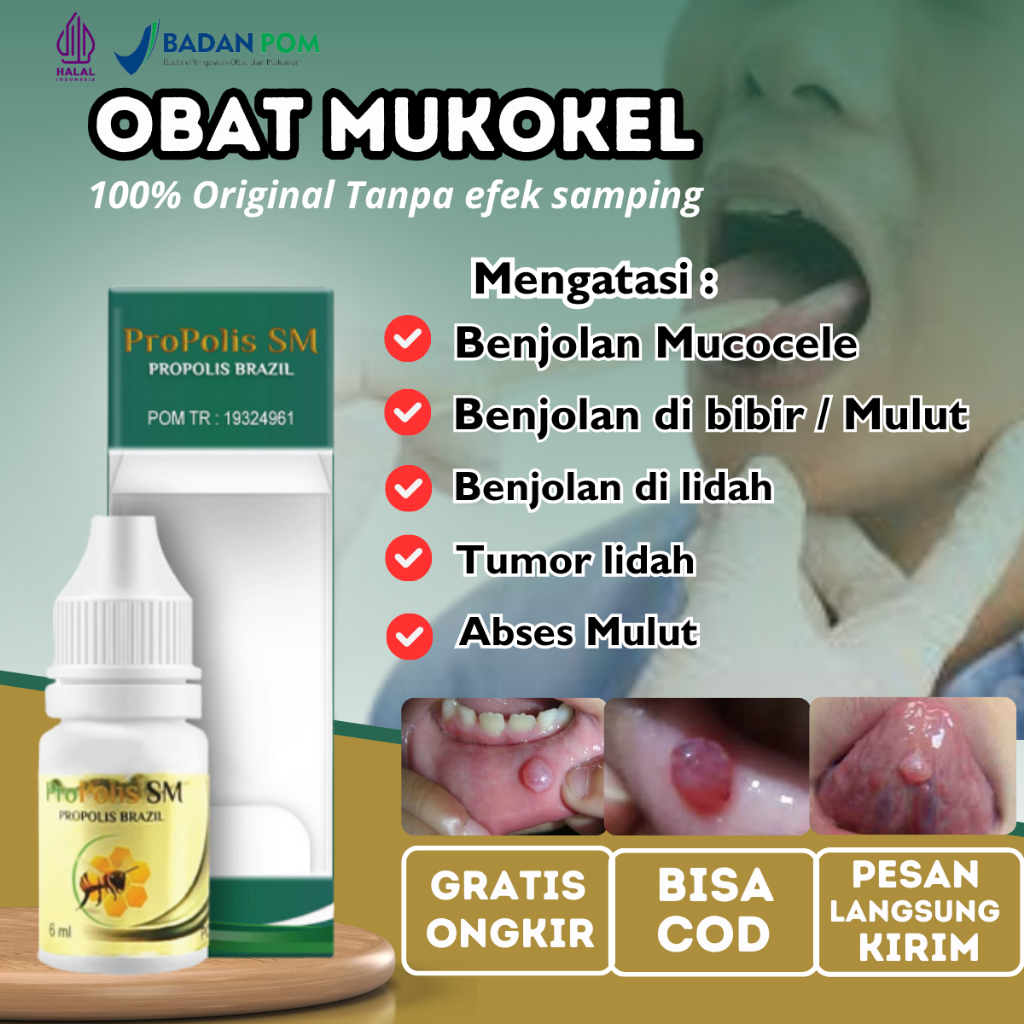 Jual Obat Mukokel, Penghilang benjolan di bawah lidah, Obat benjolan ...