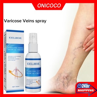 Jual Herbal Varicose Veins Treatment Spray Ubat Vena Varikos Phlebitis ...