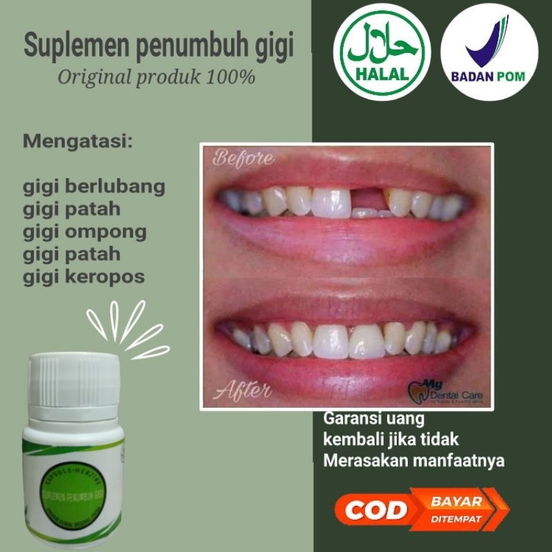 Jual PENUMBUH GIGI ALAMI - Gigi Ompong Tertambal Lagi,Gigi Patah Rapih ...