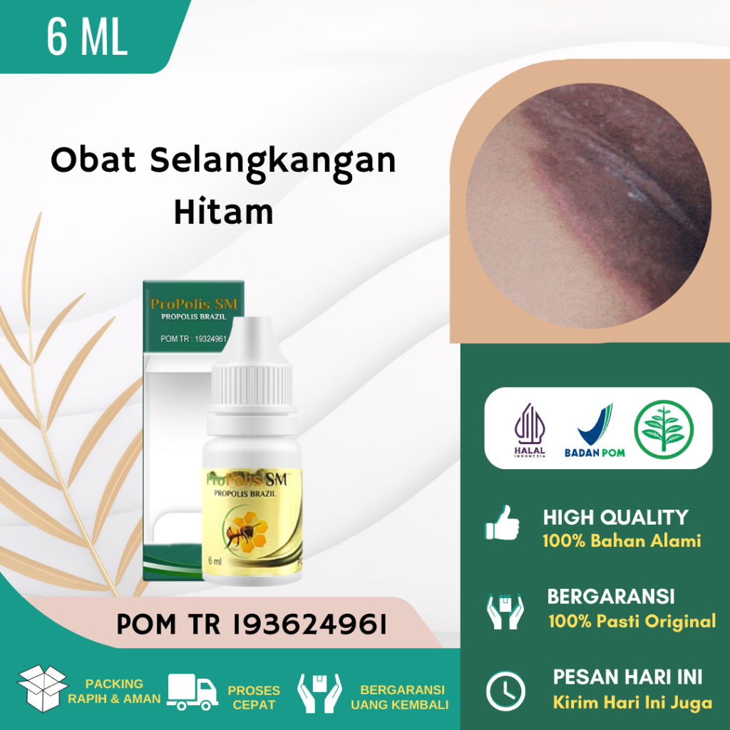 Jual Obat Selangkangan Lecet Berjamur - Obat Infeksi Jamur Kulit Paha - Selangkangan Babak ...