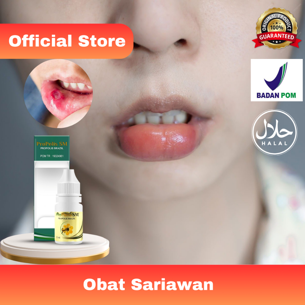 Jual Obat Sariawan, Bibir Pecah Pecah, Herpes Di Bibir, Sariawan Di ...