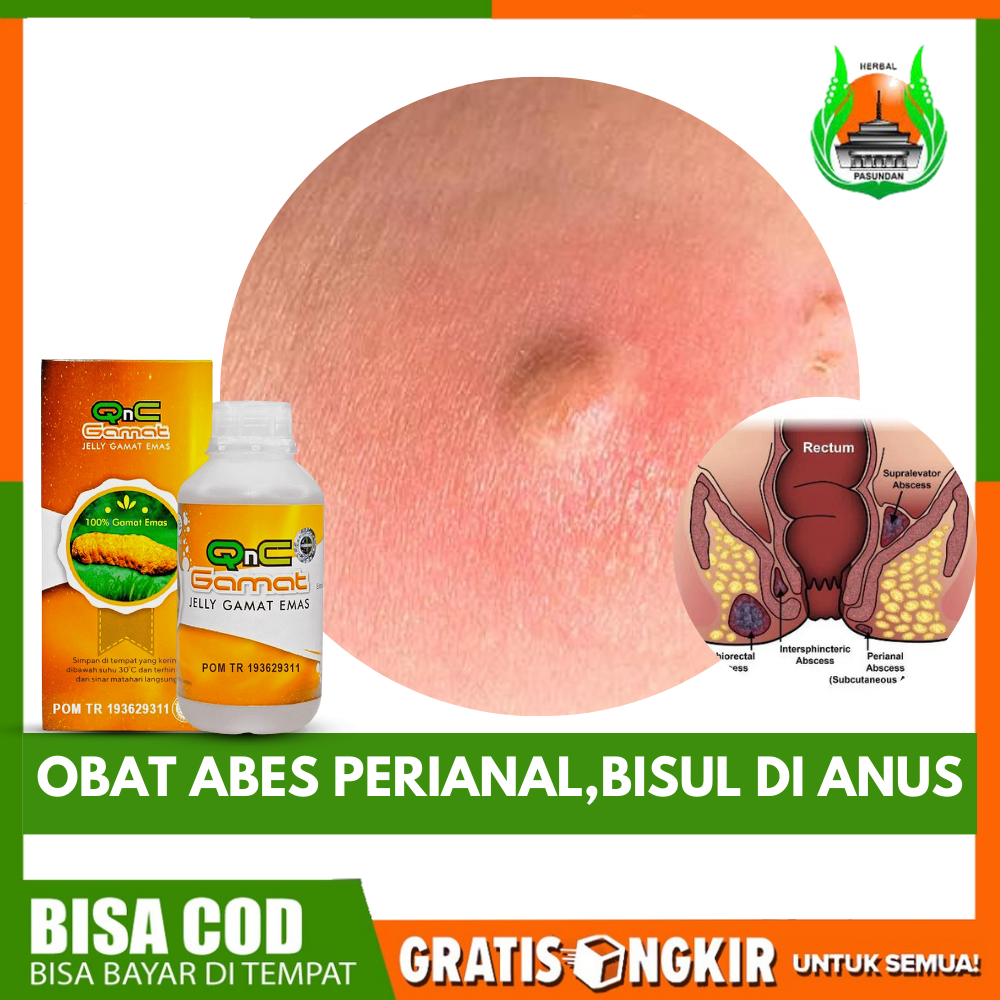 Jual Obat Abses Perianal Herbal Bisul Bernanah Dekat Anus , Benjolan Bernanah , Ambeien Akut ...