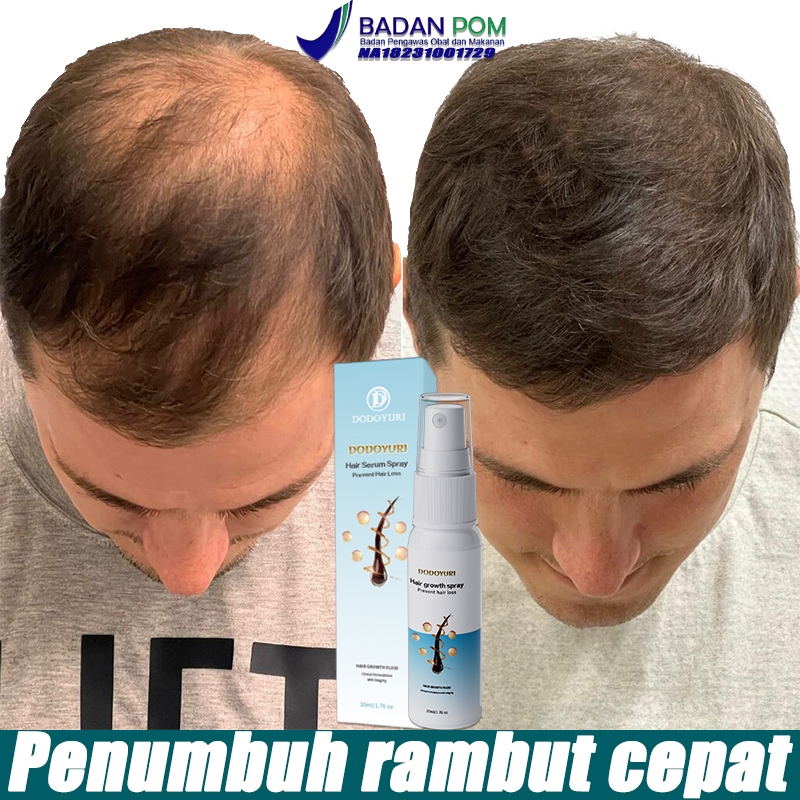 Jual (BPOM) Serum penumbuh rambut penumbuh rambut botak penumbuh rambut ...