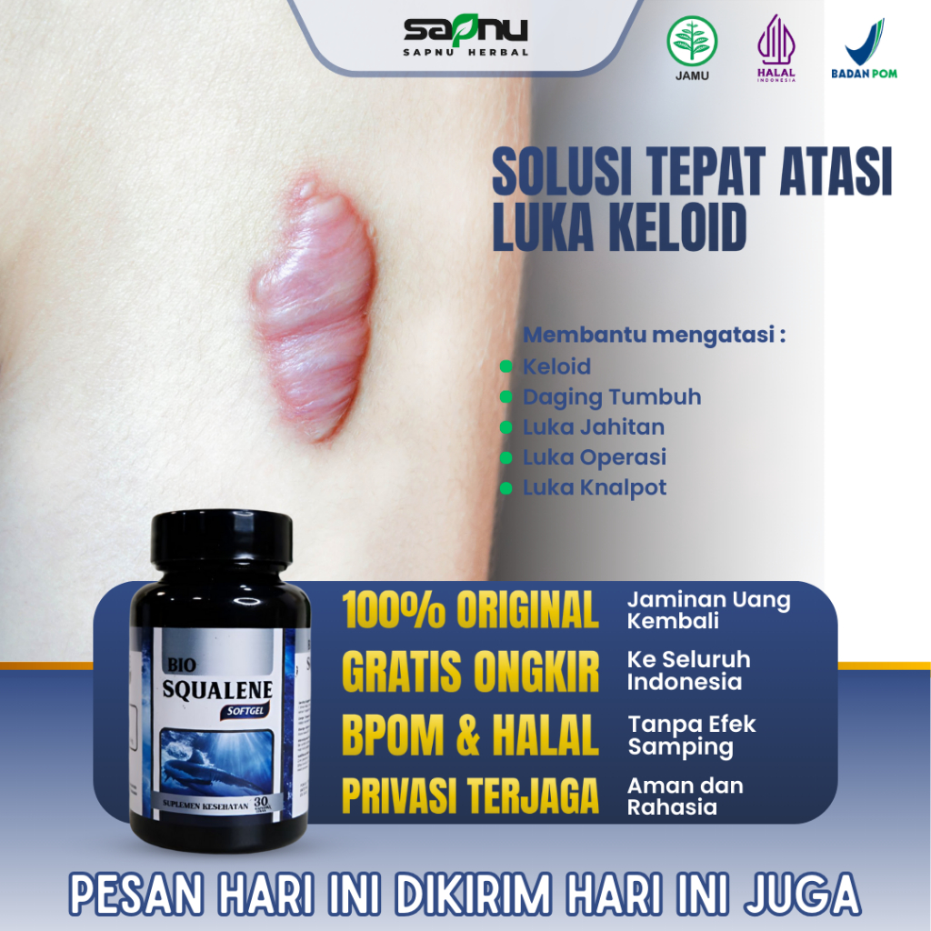Jual Bio Squalene Obat Penghilang Keloid, Keloid Di Telinga, Benjolan ...