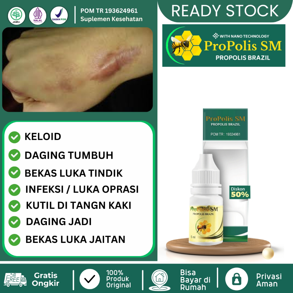 Jual Obat Keloid, Penghilang keloid, Daging Tumbuh, Daging Jadi, Skin ...