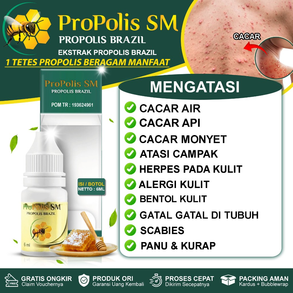 Jual Obat Cacar Air Cacar Api Atasi Campak Bintik Di Kulit Alergi Kulit ...