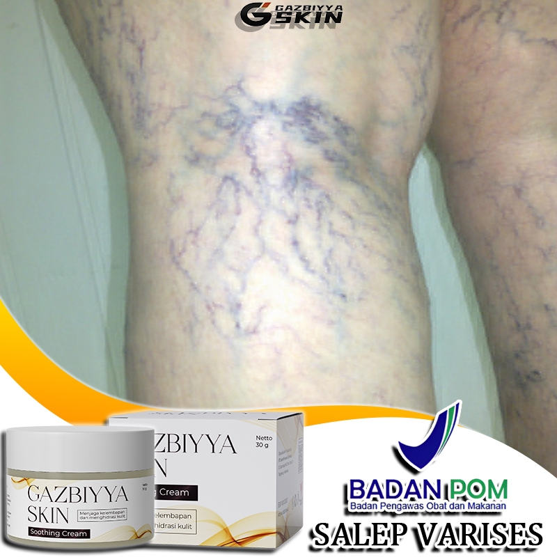 Jual Cream varises paling ampuh original salep varises obat varises ...
