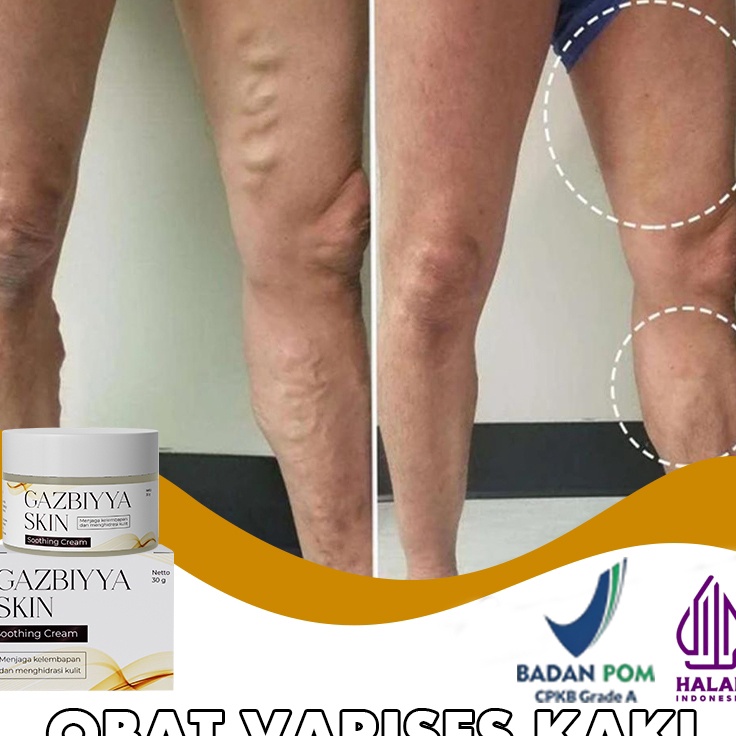 Jual STOK SIAP COD Obat varises kaki valesin obat varises original ...