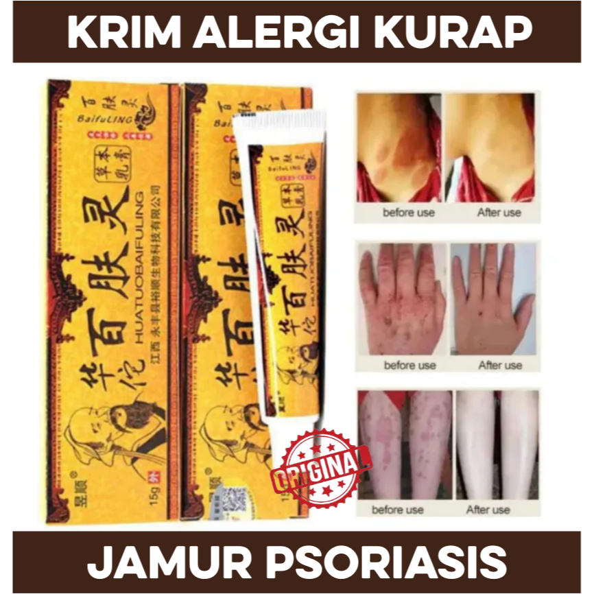 Jual Salep Cream Jamur Kurap Alergi Kulit Psoriasis Eksim Krim 100% ...