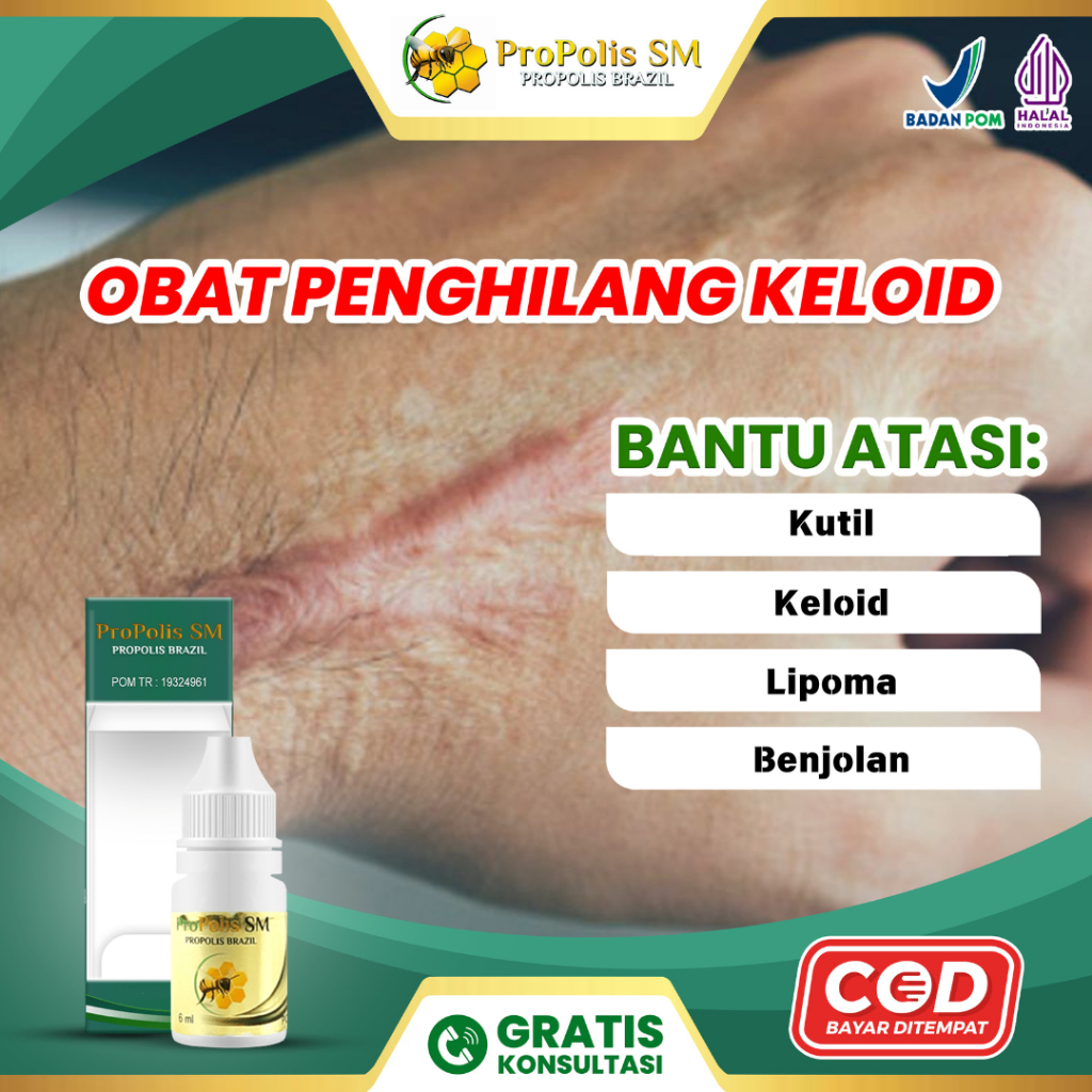 Jual Obat Penghilang Keloid, Keloid Menahun / Keloid Menonjol, Daging Jadi, Daging Tumbuh ...