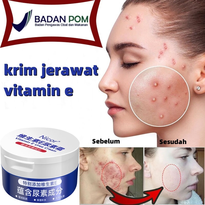 Jual jerawat Krim wajah cream penghilang bekas Krim wajah anti aging ...