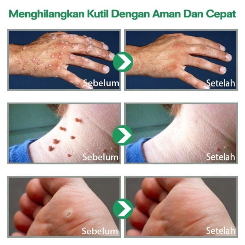 Jual CARA CEPAT HILANGKAN SEMUA JENIS KUTIL/KUTIL KELAMIN PRODUK ASLI ...
