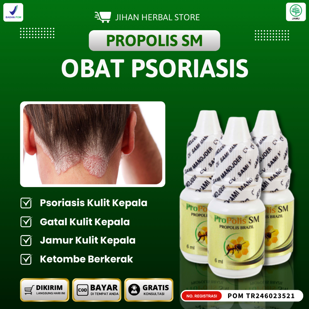 Jual Obat Psoriasis Kulit Kepala Gatal Ketombe Parah Berkerak Koreng Jamur Kulit Kepala ...