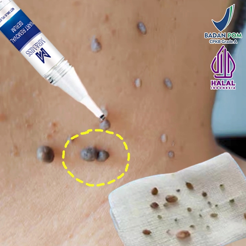 Jual Penghilang Tahi Lalat Penghilang Kutil Penghilang Tahi Lalat Di ...