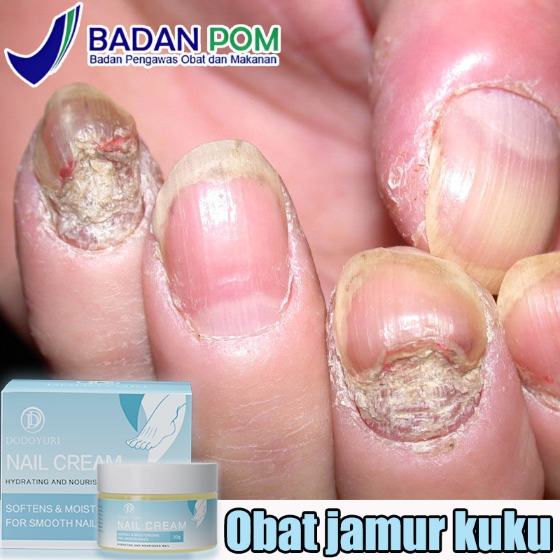 Jual {BPOM}Obat jamur kuku Obat kuku jamur dan rusak Perawatan kuku 30g ...