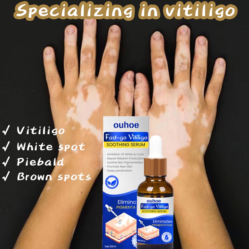 Jual Pengobatan Vitiligo obat vitiligo ampuh /protopic Vitiligo alep ...