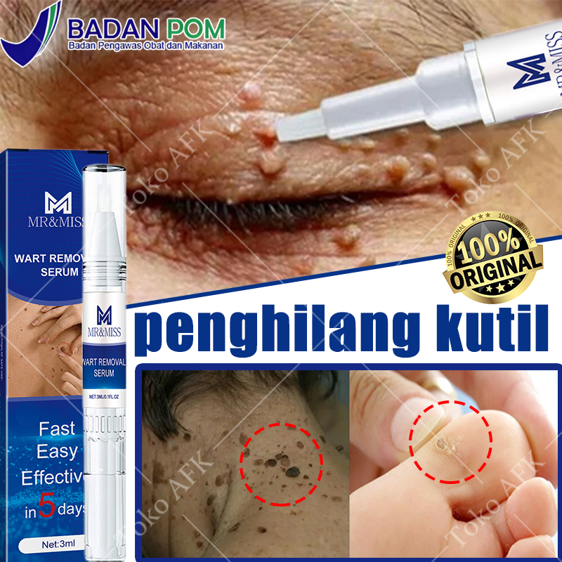 Jual Obat Penghilang Kutil Penghilang kutil di wajah Penghilang tahi ...