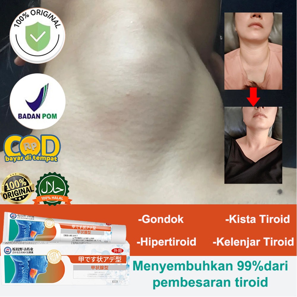 Jual Obat tiroid yang paling Ampuh krim tiroid 20g Khusus Obat Gondok ...