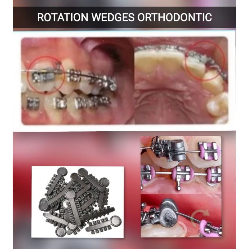 Jual Rotation Wedges Orthodontic | Shopee Indonesia