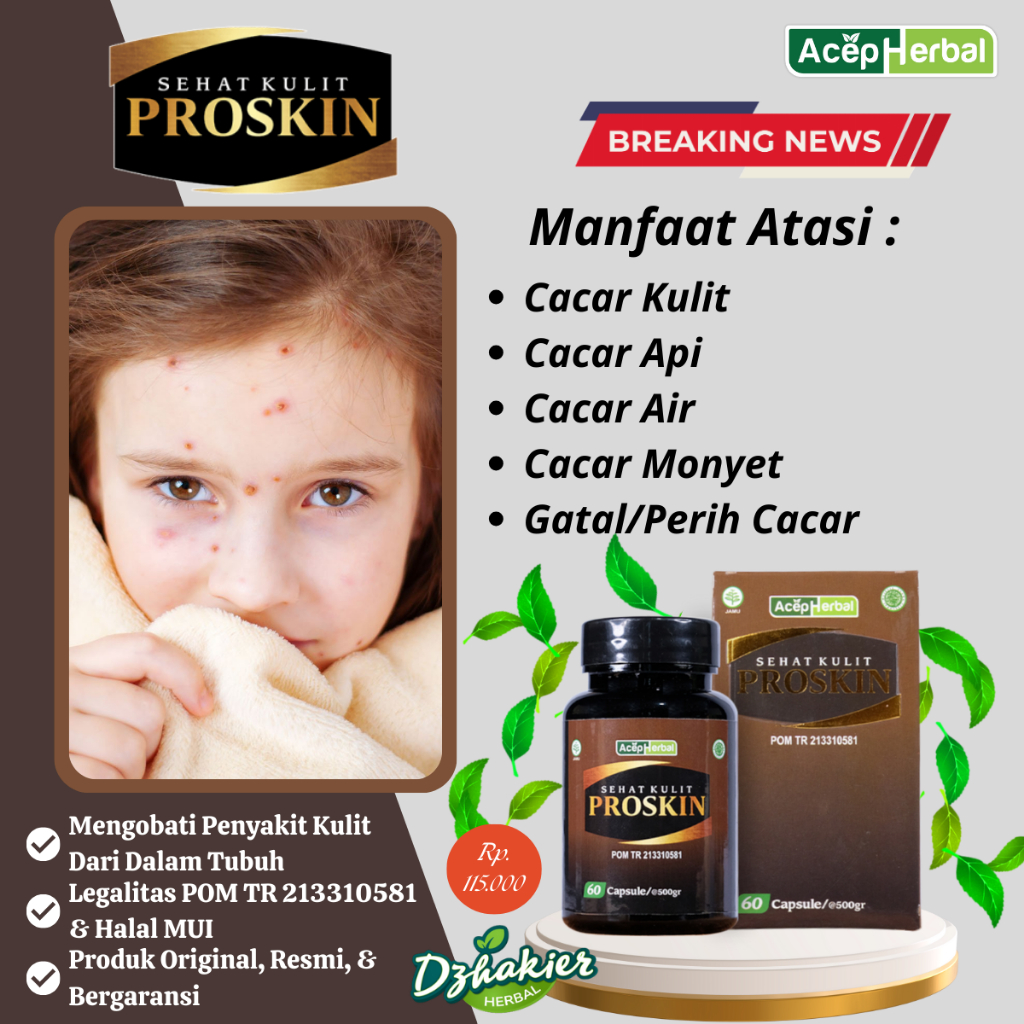 Jual Obat Cacar Kulit, Cacar Monyet, Cacar Api, Cacar Air, Gatal Dan ...