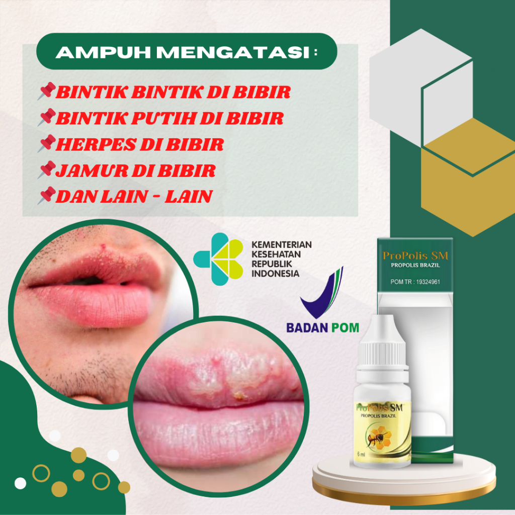 Jual Obat Menghilangkan Bintik Putih di Bibir, Obat Bercak Putih Di ...