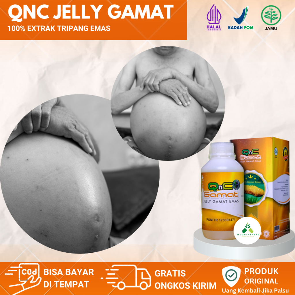 Jual Qnc Jelly Gamat Obat Asites, Perut Bengkak, Penumpukan Cairan ...