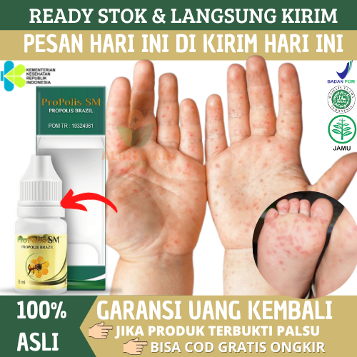 Jual Obat Kutu Air Di Tangan, Obat Kutu Air Di Jari, Obat Kutu Air Di ...