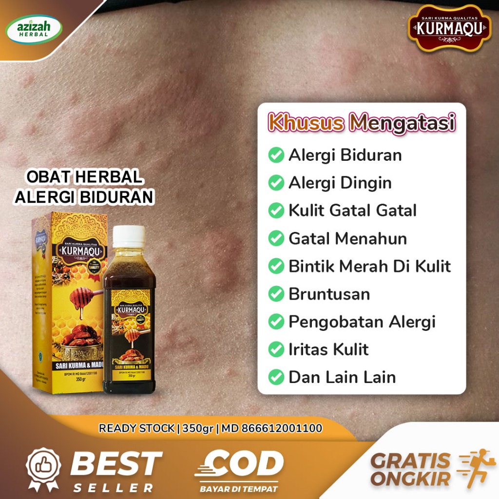 Jual Obat Alergi Dingin Biduran Kaligata Gatal Gatak Menahun Bintik ...