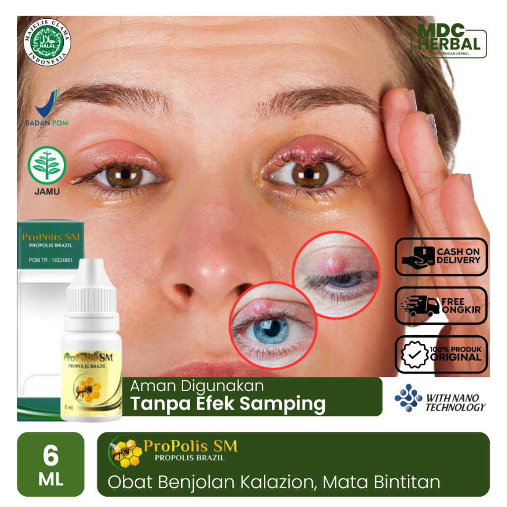 Jual Obat Kalazion Mata Bintitan Penghilang Benjolan di Kelopak Mata ...