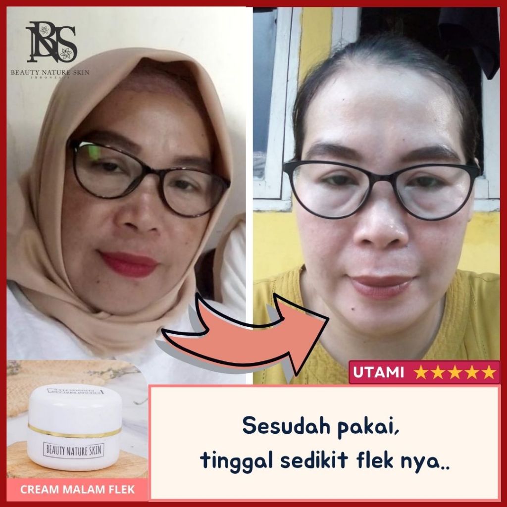 Jual Cream Malam Khusus Flek | Flek Hitam Dijamin Hilang Dalam 4 Minggu | Cream Malam Penghilang ...