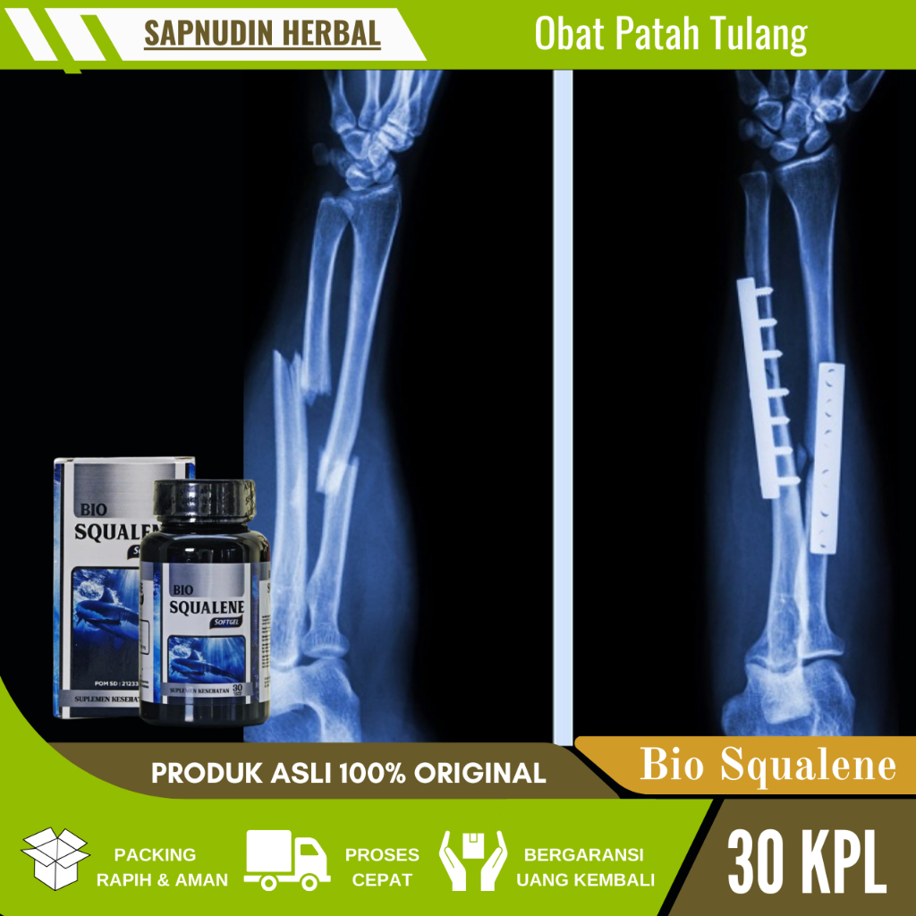 Jual Obat Patah Tulang, Obat Patah Tulang Dan Retak, Obat Patah Tulang ...