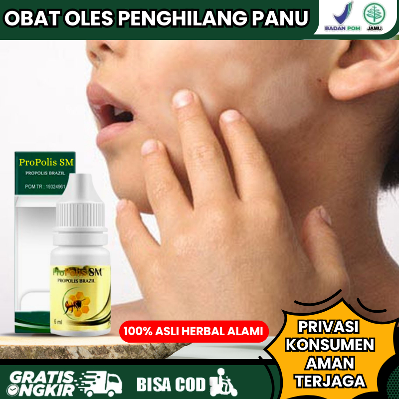 Jual Obat Tetes Membersihkan Panu Bercak Putih di Tubuh, Basmi Jamur ...