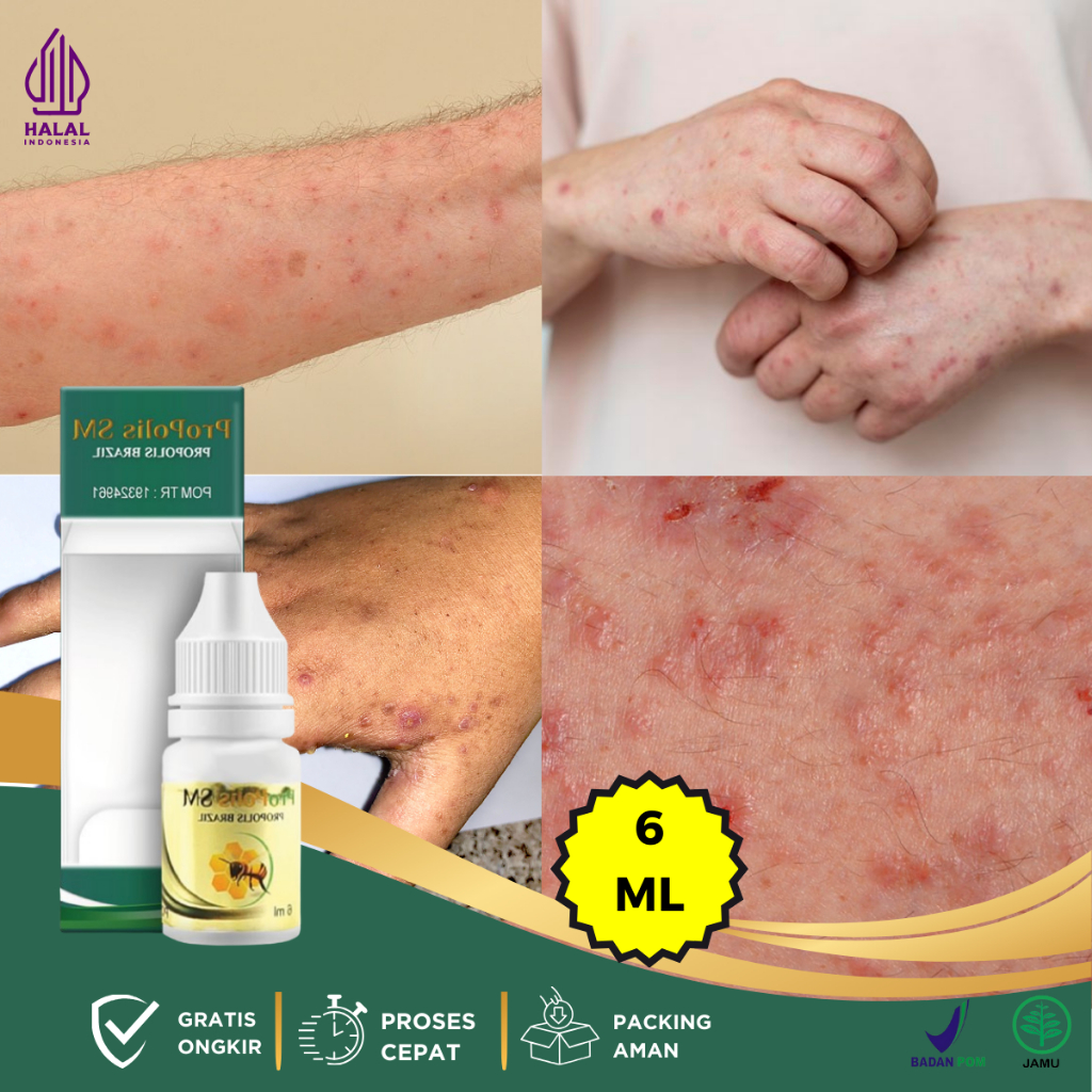 Jual Obat Scabies Rasa Gatal Kemerahan Scabies Kulit Borok Bernanah ...