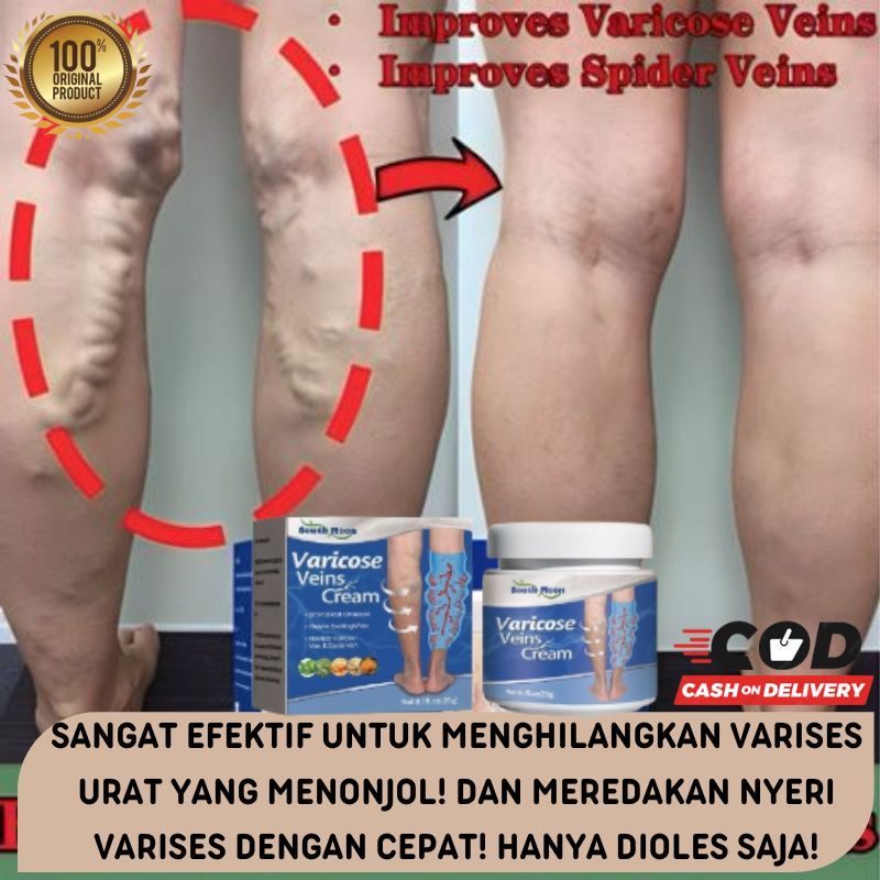 Jual Varicose Veins Cream Krim Penghilang Varises Herbal | Shopee Indonesia
