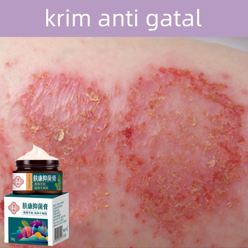 Jual Salep Gatal Paling Ampuh Obat Psoriasis Eksim Jamur Kurap Alergi Kulit Cream Salep