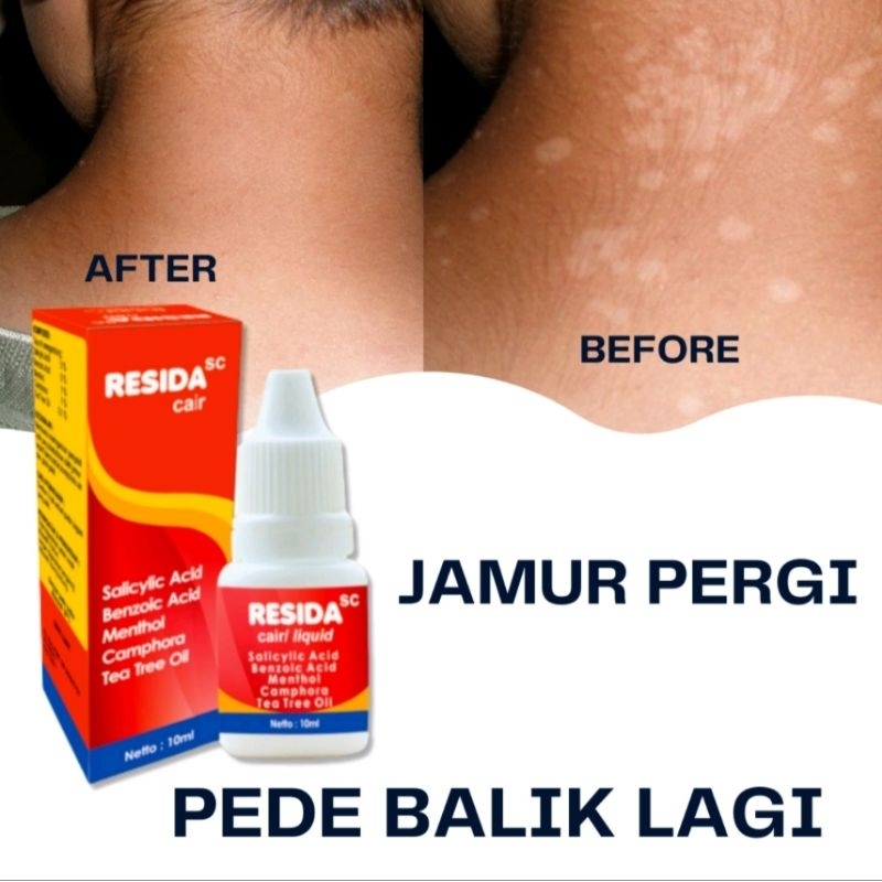 Jual Resida Cair Original Pengganti Kalpanax Mengatasi Panu Kadas Kurap ...